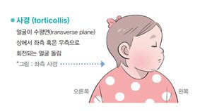 "아기 '기운목', 병원에서 정확히 진단하고 치료해야" : 네이트 뉴스