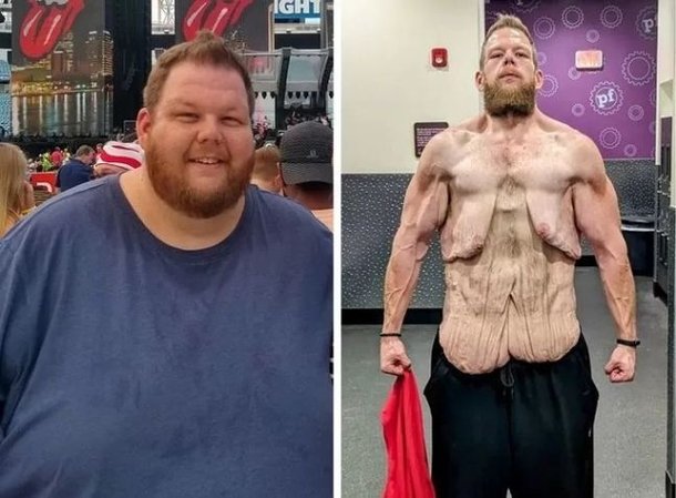 150kg 감량 후 상의 탈의한 男 "사진 올리기 꺼렸지만…" : 네이트 뉴스