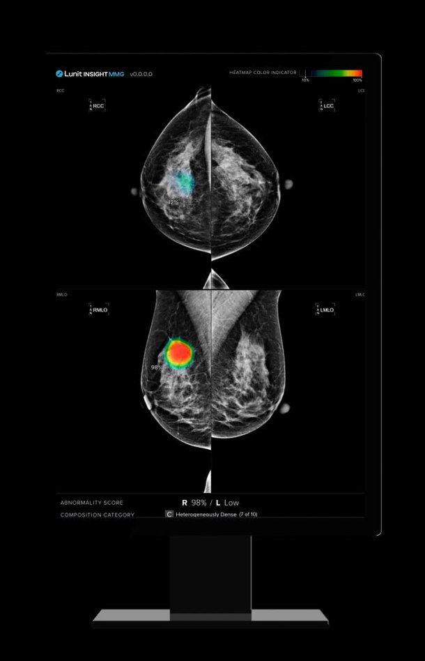 루닛, AI 유방암 검진 '루닛 인사이트 MMG' 대만 허가 획득 : 네이트 뉴스
