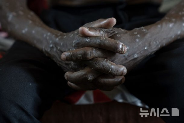 아프리카 엠폭스 사망자 1000명 넘었다…확산 비상 네이트 뉴스