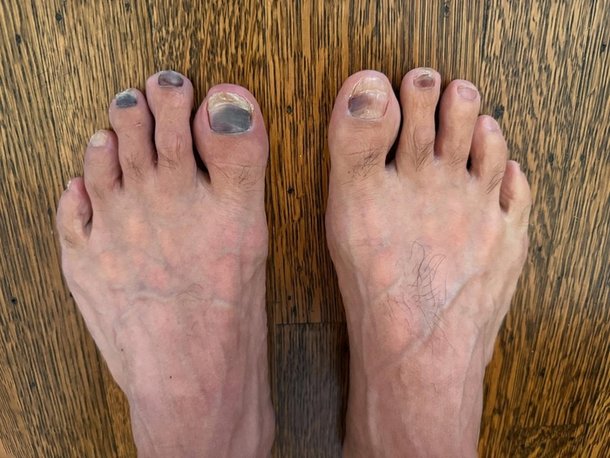 "81.5km의 흔적"…션의 투혼이 남긴 '영광의 상처' | 아이돌24시 : 네이트 연예