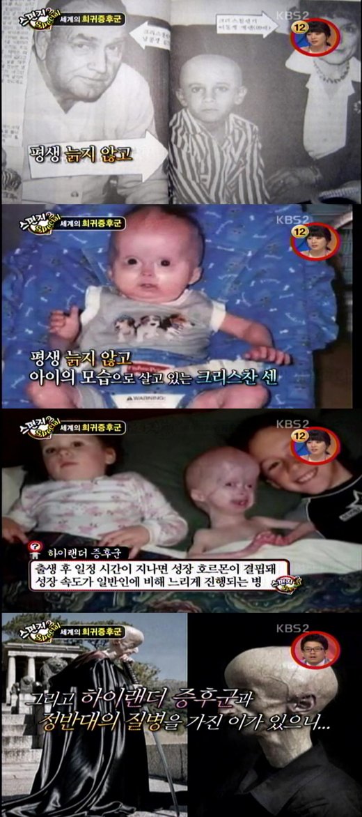 하이랜더 증후군 선천성 조로증 극과 극 희귀병 뭐기에 네이트 연예